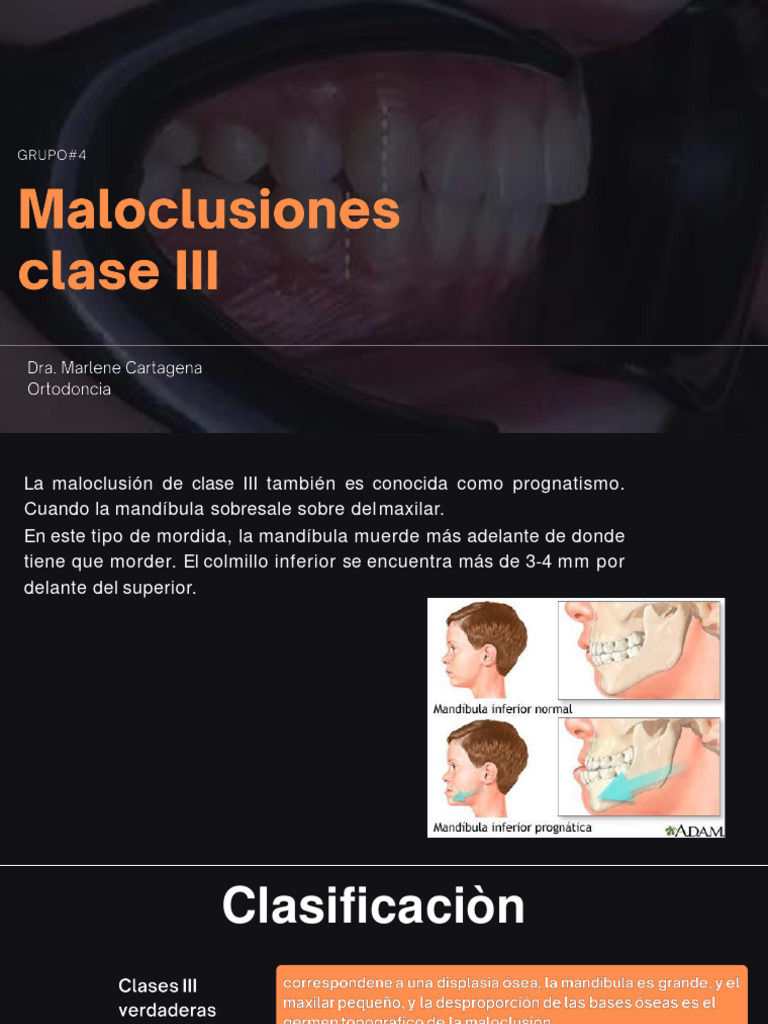 Maloclusión Clase III: Prognatismo y Tratamiento | PDF | Artes del ...