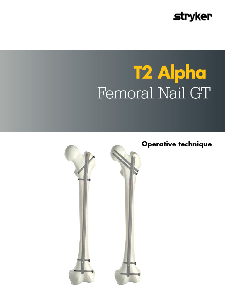 Surgical Guide: T2 Alpha Femoral Nail | PDF | Magnetic Resonance ...