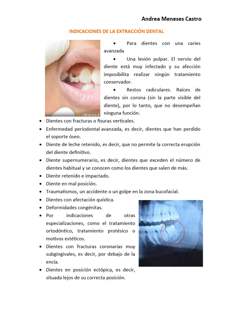INDICACIONES DE LA EXTRACCIÓN DENTAL | PDF | Odontología | Medicina CLINICA