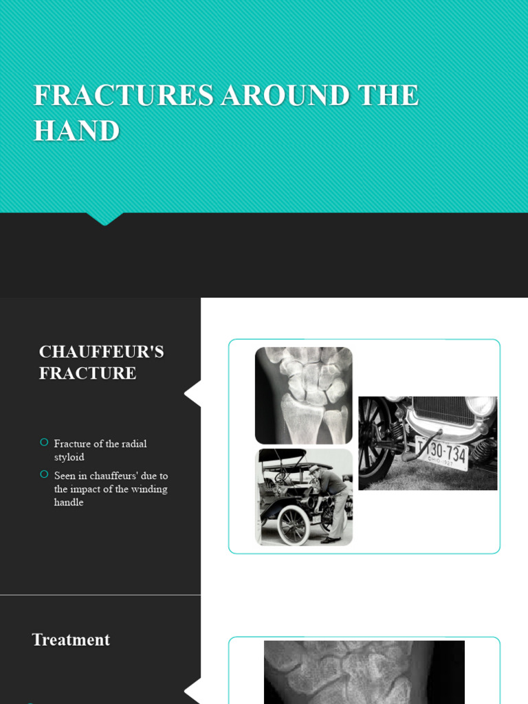 Hand Fractures: Types and Management | PDF | Hand | Musculoskeletal ...