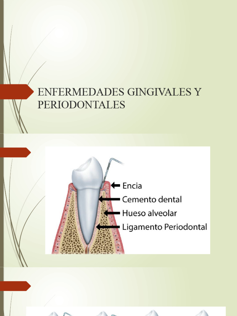 Unidad 4 Enfermedades Gingivales y Periodontales | PDF | Cuidado de la ...