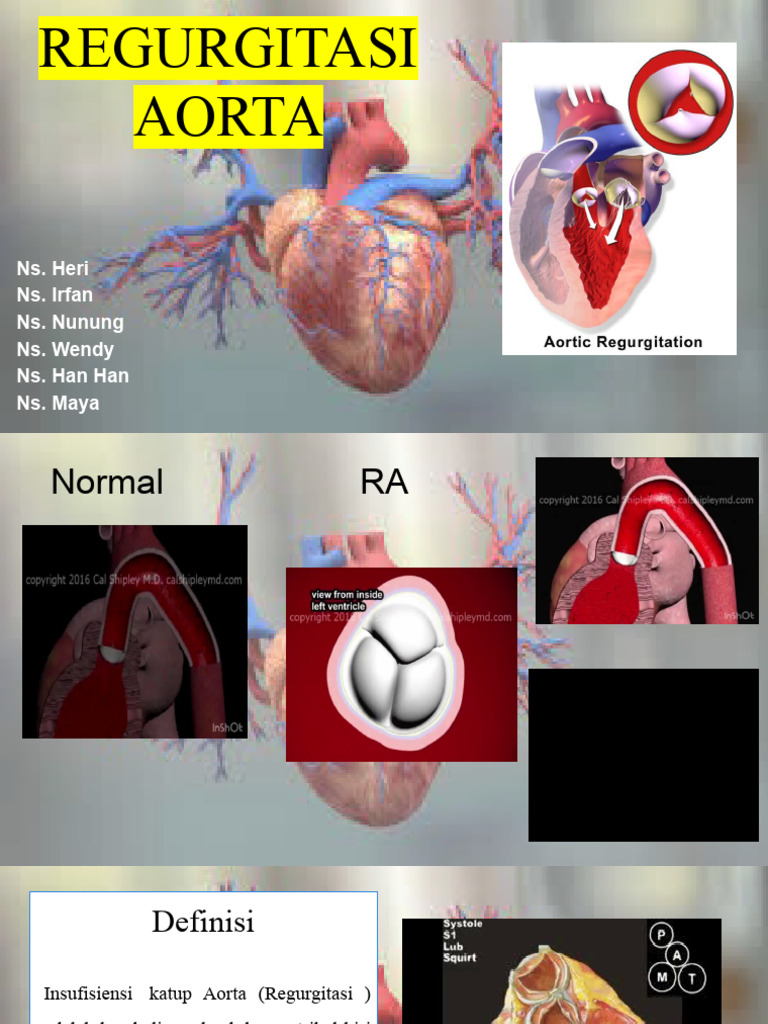 Regurgitasi Aorta | PDF