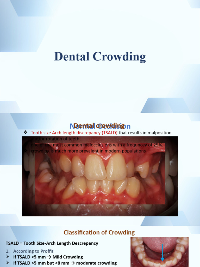 Dental Crowding Abdullah | PDF | Dentistry Branches | Dental Anatomy