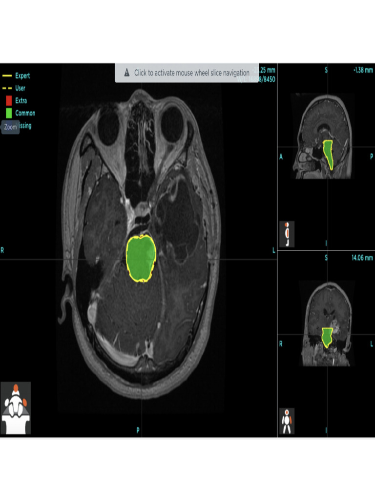 Brainstem Contour | PDF