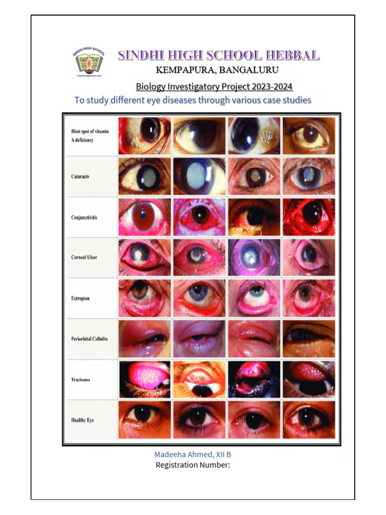 Case Study on Eye Diseases | PDF | Human Eye | Cataract