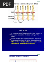 ECG Limb Lead Reversal - LITFL - ECG Library Diagnosis | PDF ...