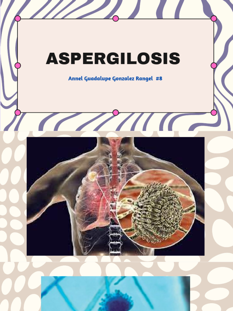 Aspergilosis - 20231104 - 155610 - 0000 | PDF | Alergia | Ciencias de la Salud