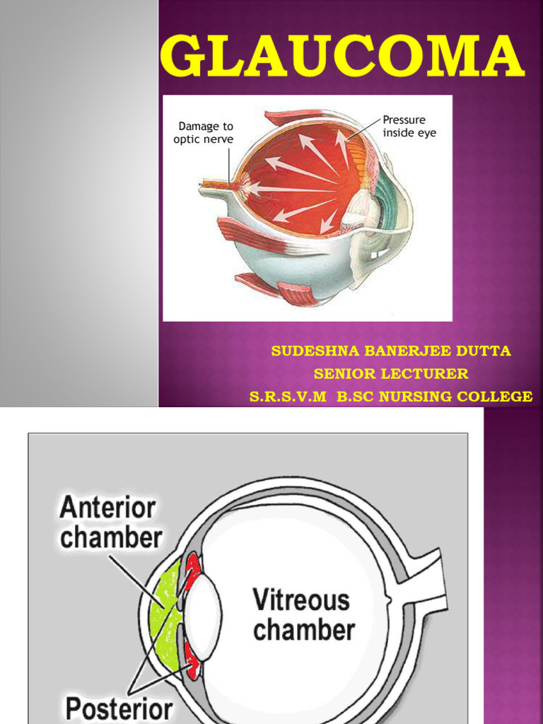 Glaucomanew Converted 210627175813 | PDF | Glaucoma | Visual System