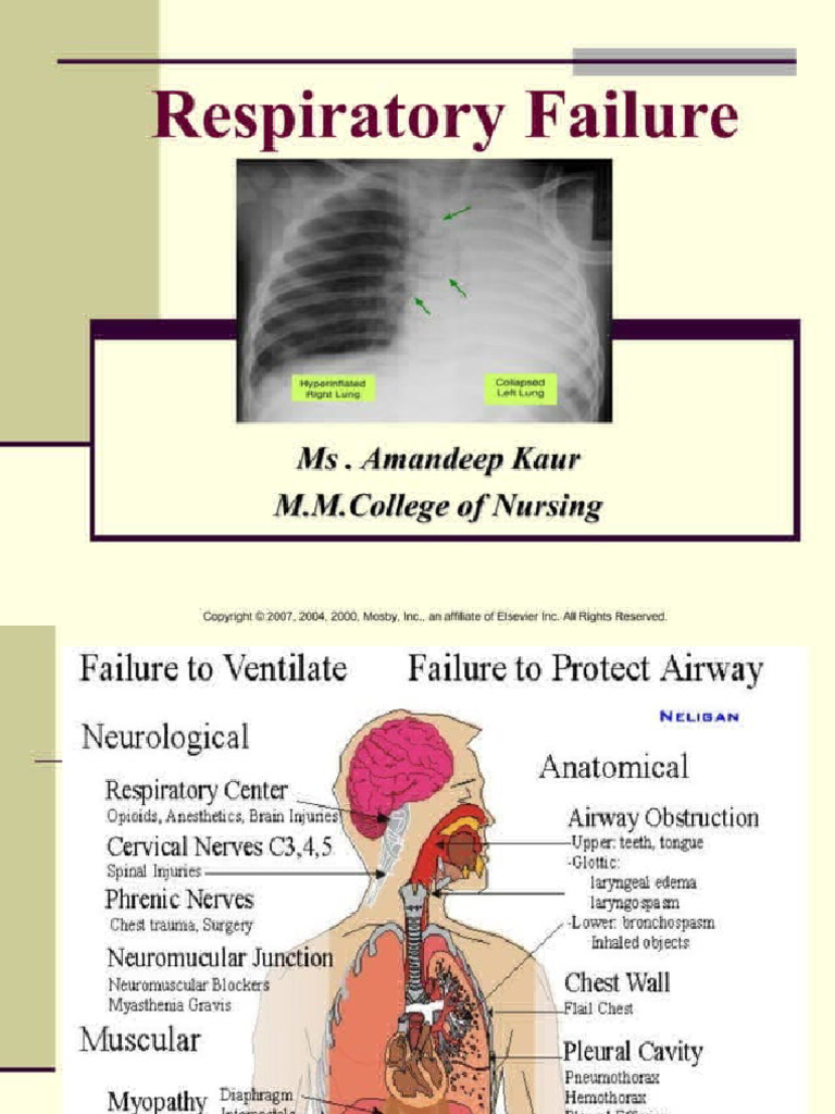 Respiratory Failure 120399291 | PDF