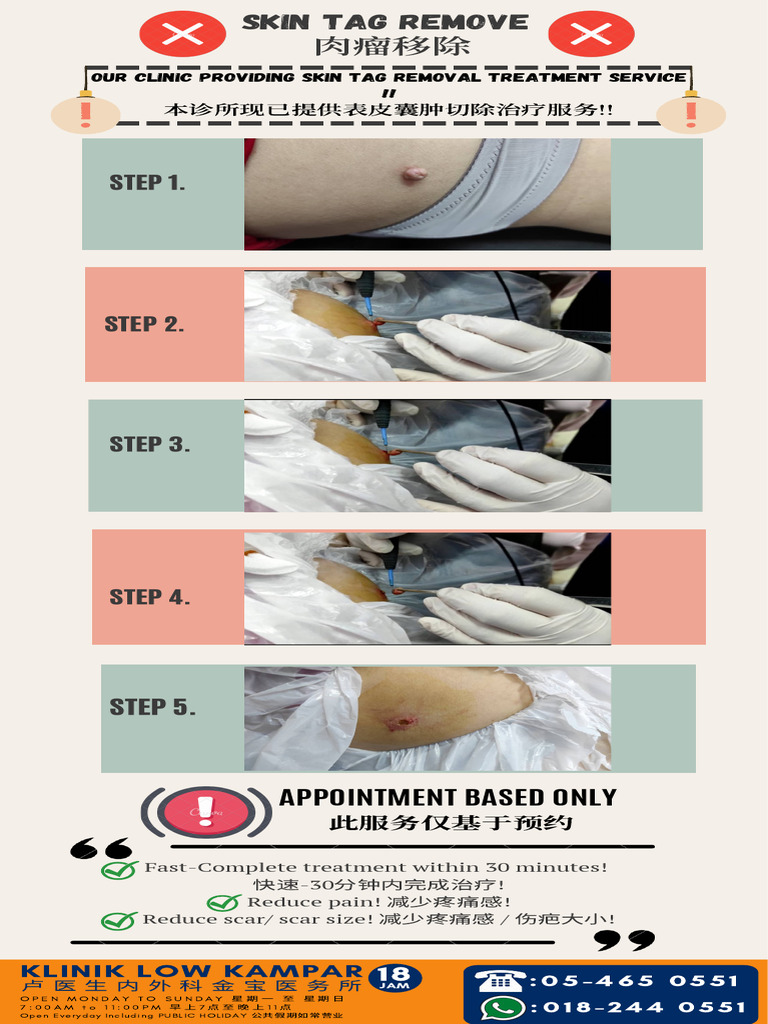 skin tag remove 肉瘤移除 | PDF