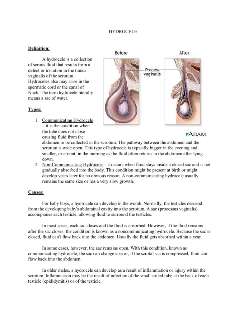 Hydrocele | PDF