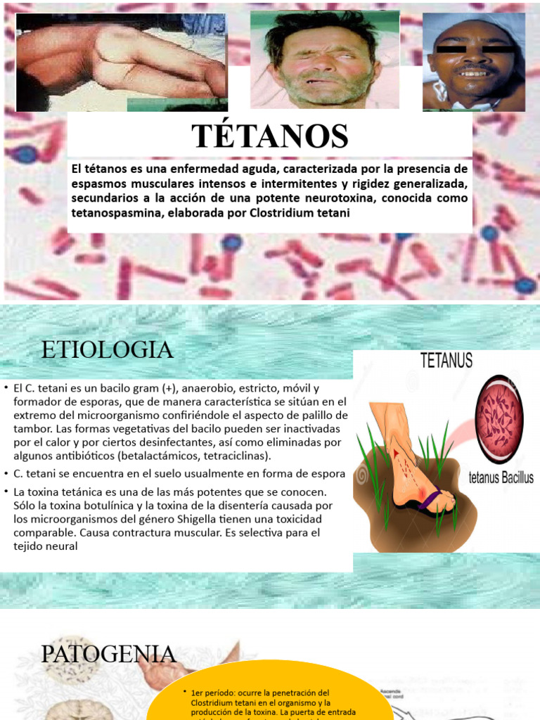 TÉTANOS | PDF | Especialidades Medicas | Medicina CLINICA