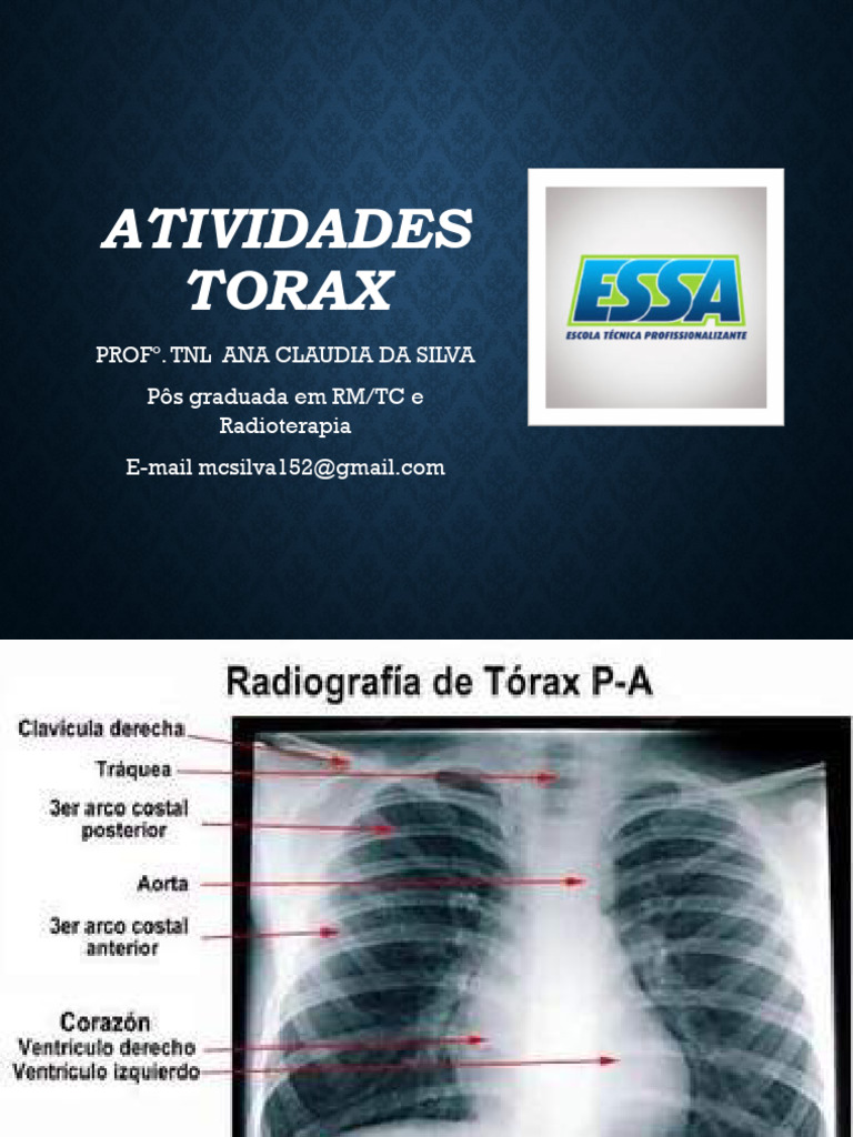 Atividades Resolvida Da Anatomia Torax Prof. Ana Claudia | PDF ...