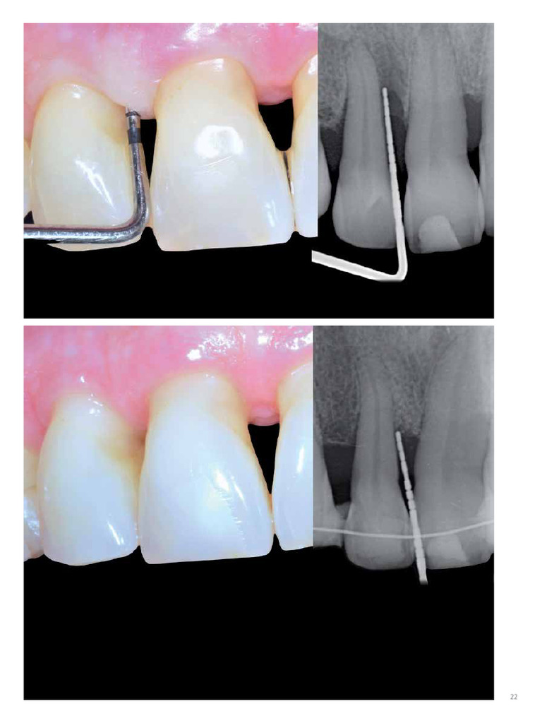 Ortiz-Vigón-et.-al.-2015-Combined-techniques-for-periodontal ...
