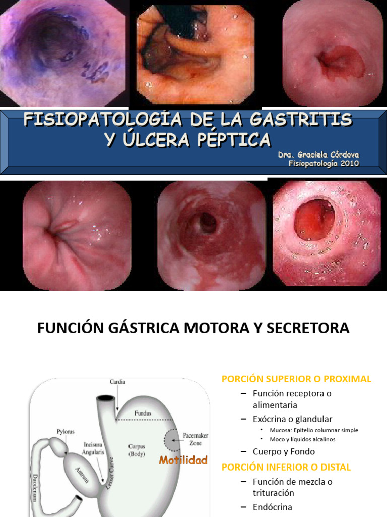 Gastritis y Úlcera Péptica | PDF | Estómago | Especialidades Medicas