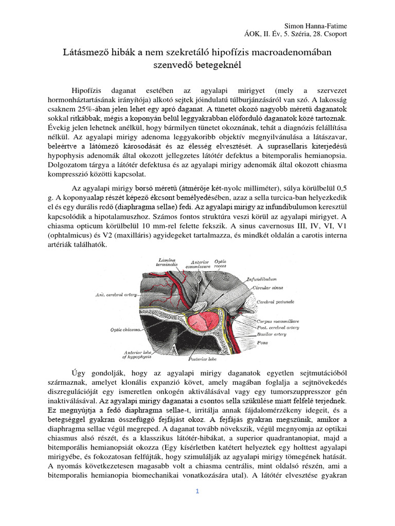Látásmező Hibák A Nem Szekretáló Hipofízis Macroadenomában Szenvedő ...