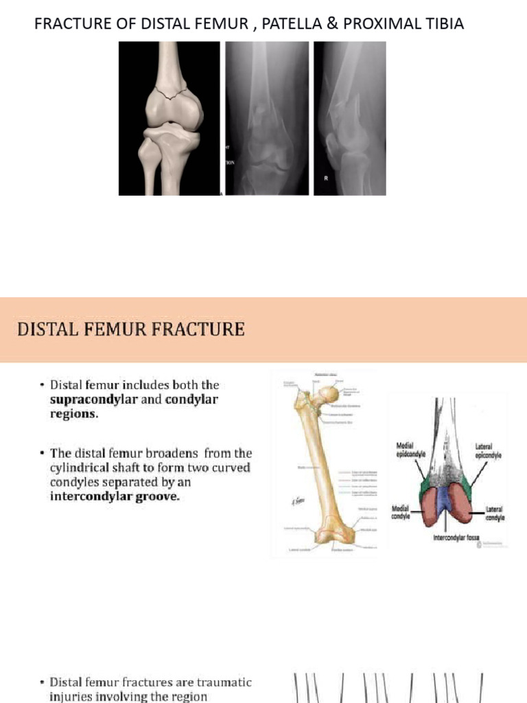 Distal Femur Patella Prox Tibia Fractures | PDF