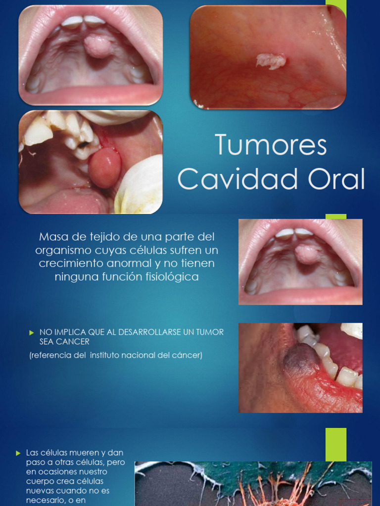 Tumores Benignos y Malignos en la Boca | PDF | Cáncer | Anatomía