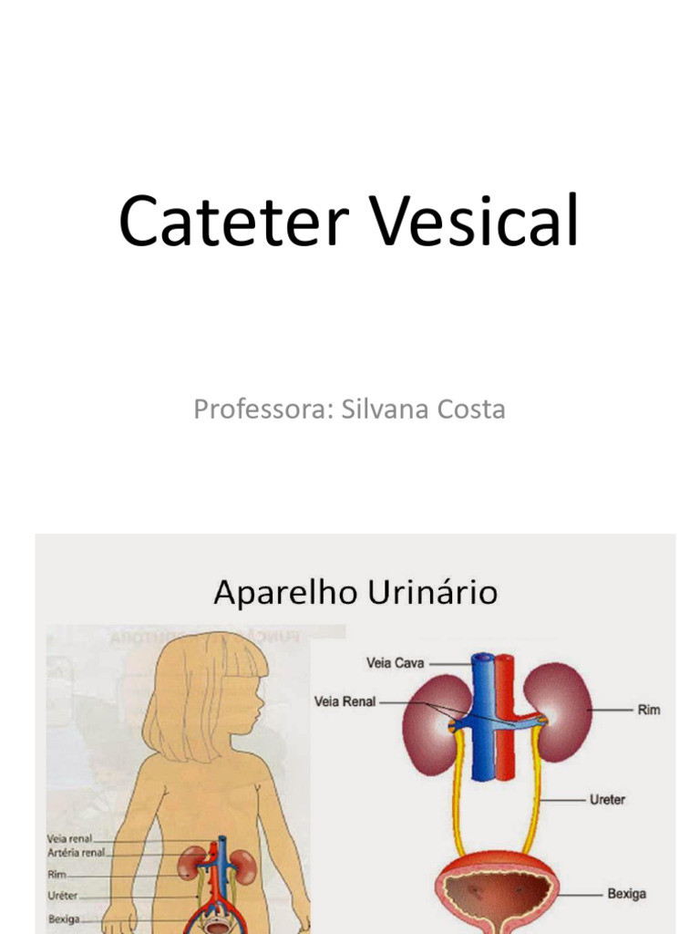 Cateter Vesical | Download grátis PDF | Micção | Medicina Clínica