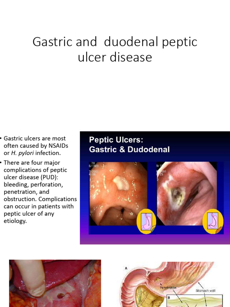 2 Gastric and Duodenal Peptic Ulcer Disease 2 | PDF | Digestive ...