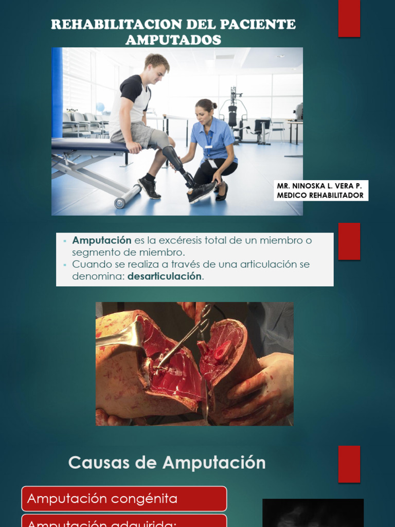 12.rehabilitacion Del Paciente Amputado | PDF | Hombro | Hueso