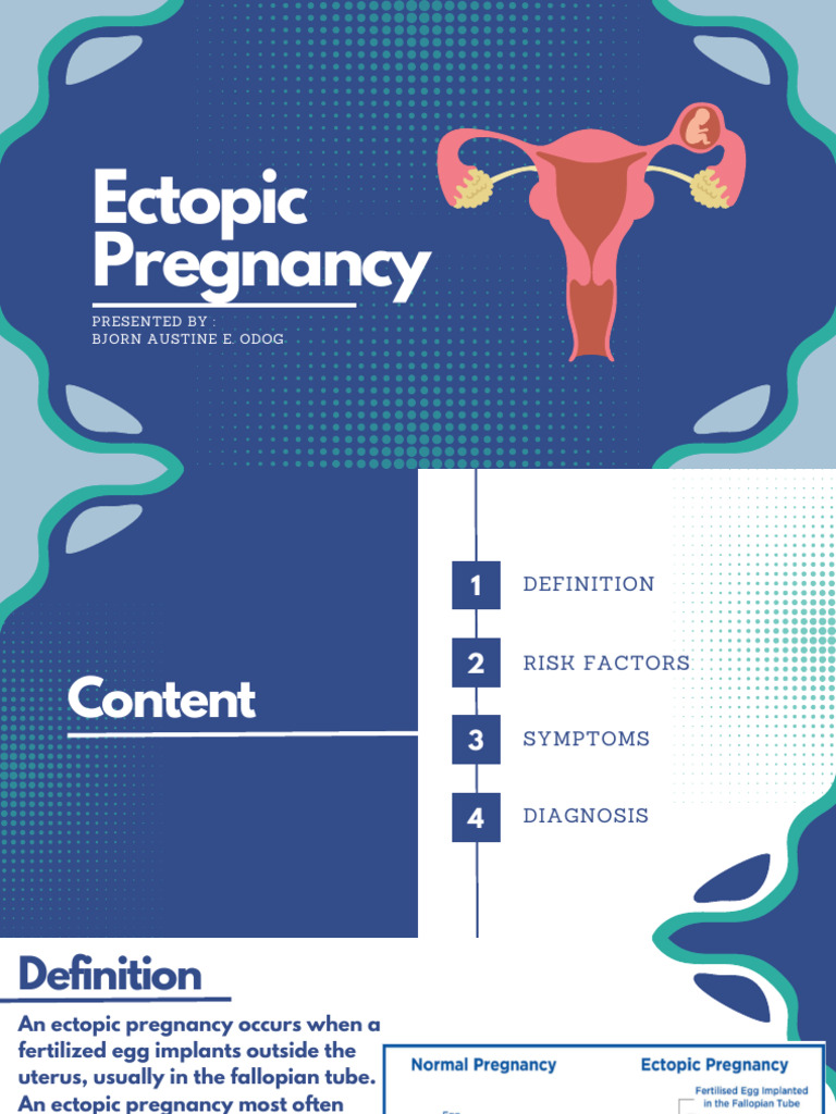 Ectopic Pregnancy: Risks & Symptoms | PDF