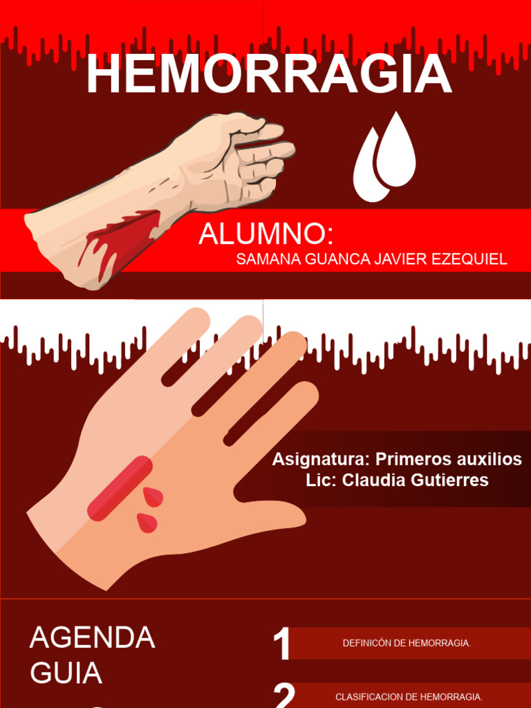 Tipos de Hemorragias y Primeros Auxilios | PDF | Sangrado | Primeros ...