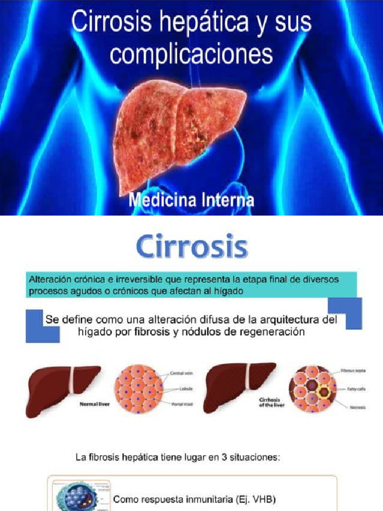 Cirrosis Hepatica | PDF