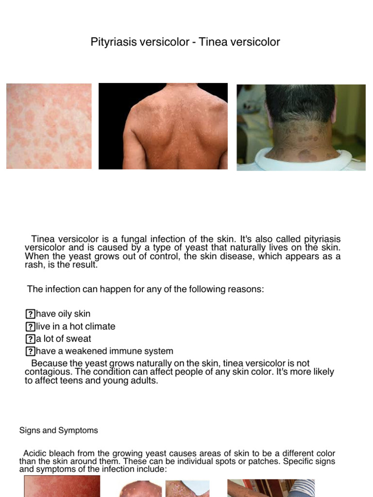Pityriasis Versicolor | PDF | Clinical Medicine | Immunology