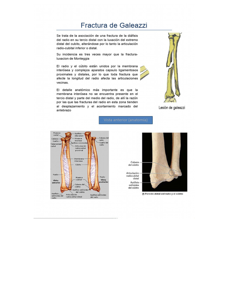 Fractura de Galeazzi: Clasificación y Tratamiento | PDF | Codo | Hueso