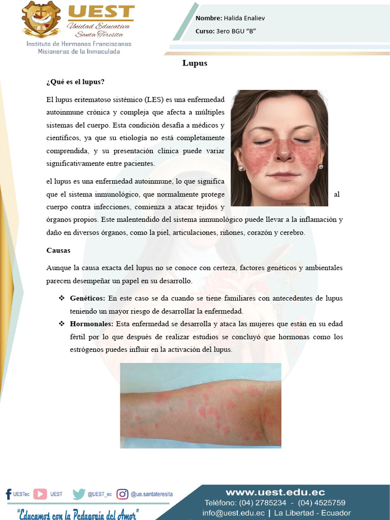 Lupus 1 | PDF