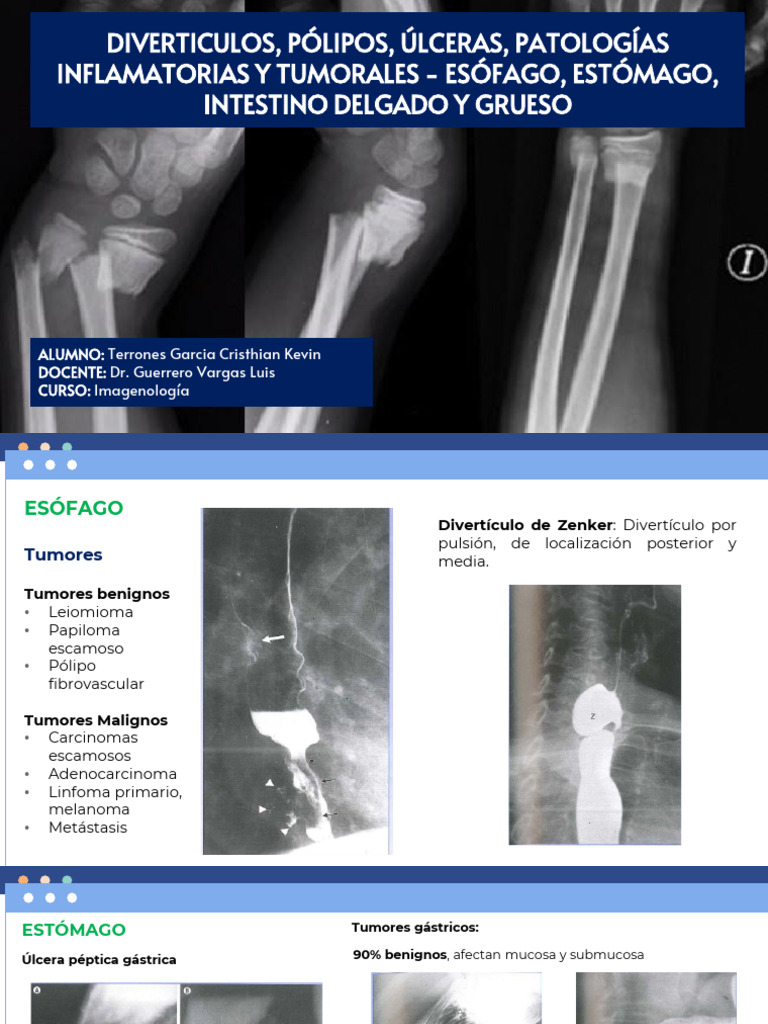 DIVERTICULOS, PÓLIPOS, ÚLCERAS, PATOLOGÍAS INFLAMATORIAS Y TUMORALES ...