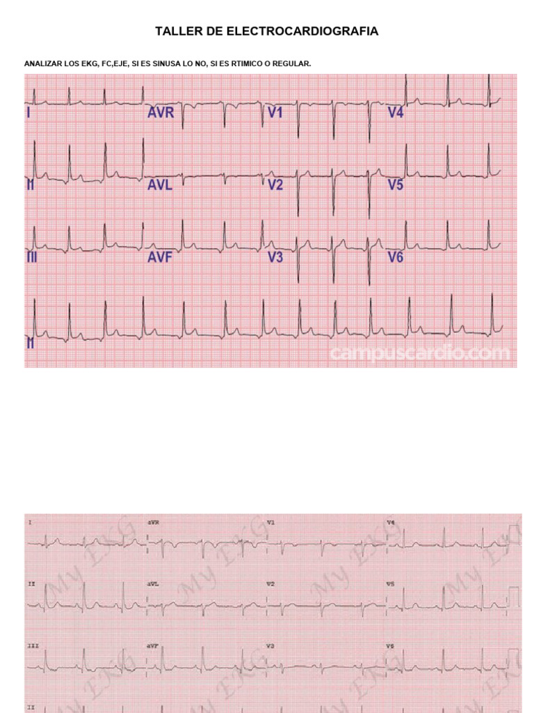 Ekg Normal Taller | PDF