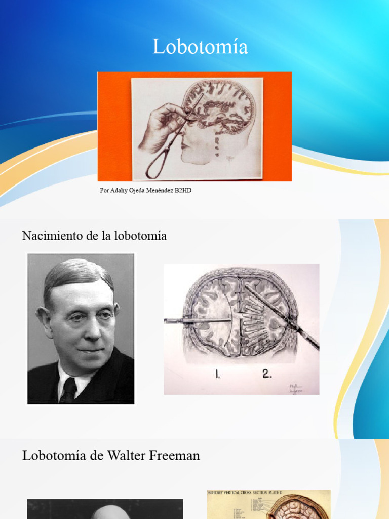 Presentacion Lobotomía | PDF
