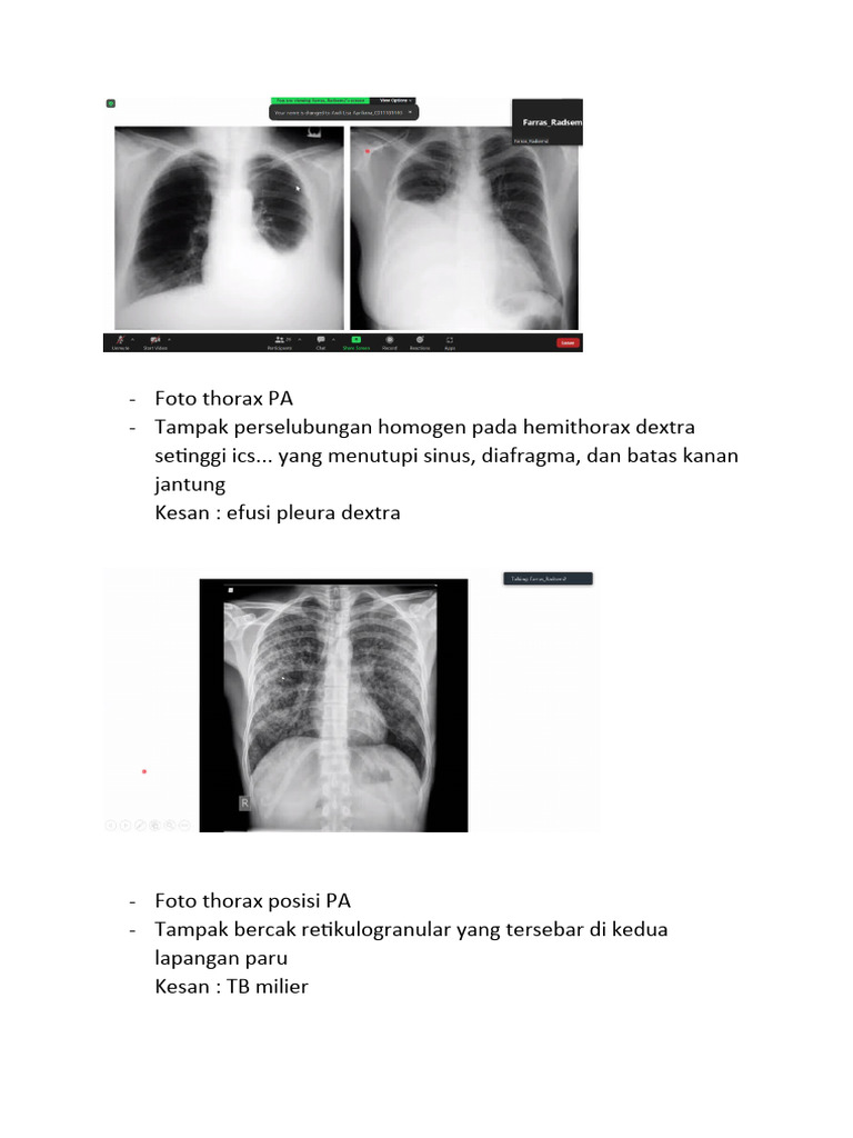 Temuan Rontgen Thorax dan Kesan Klinis | PDF