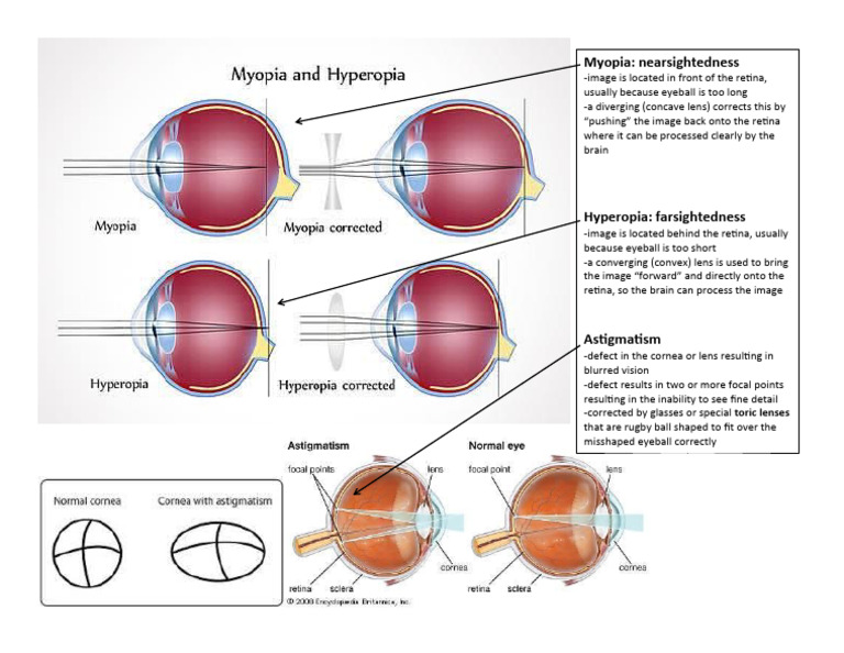 Myopia Hyperopia Diagram | PDF