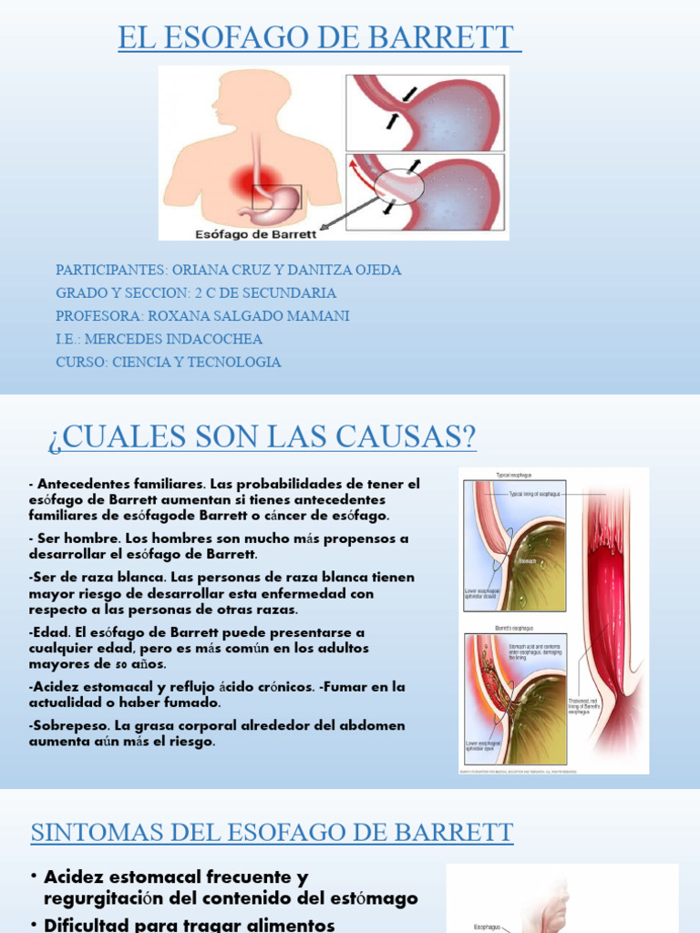 El Esofago de Barrett | PDF