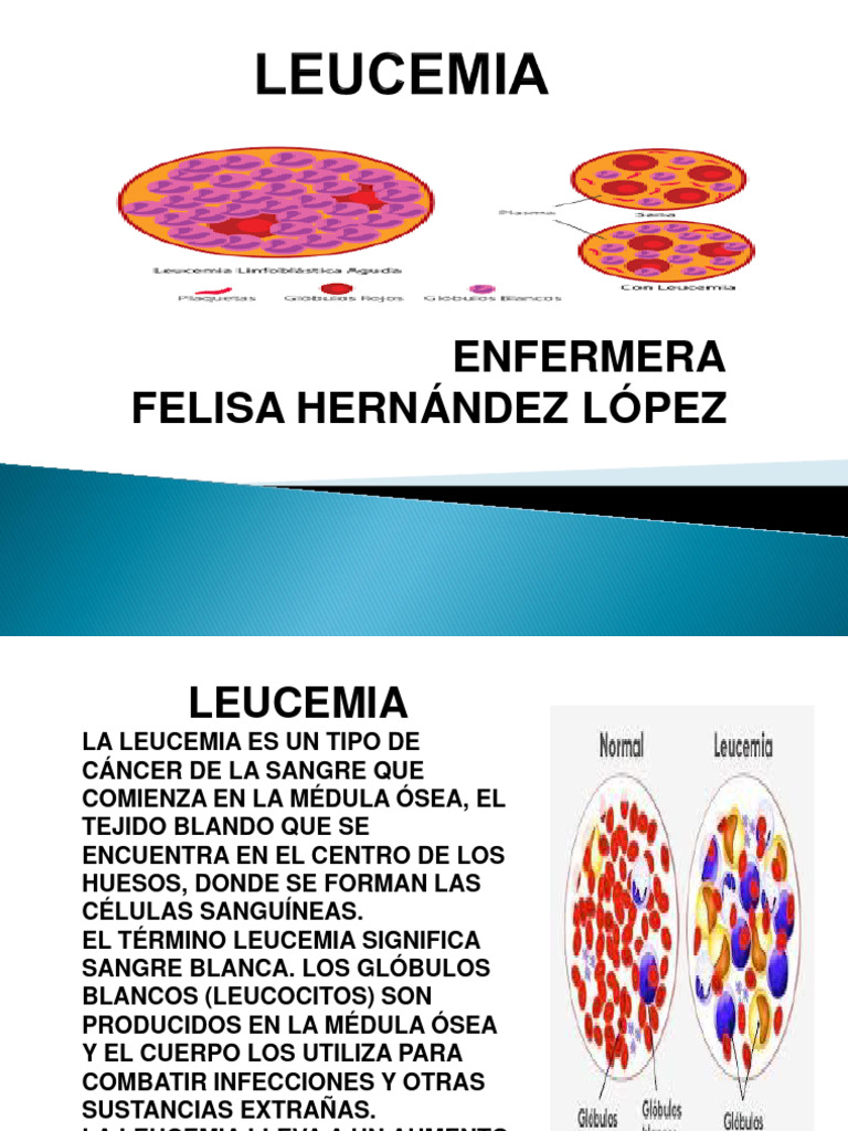 LEUCEMIA | PDF | Leucemia | Leucocito