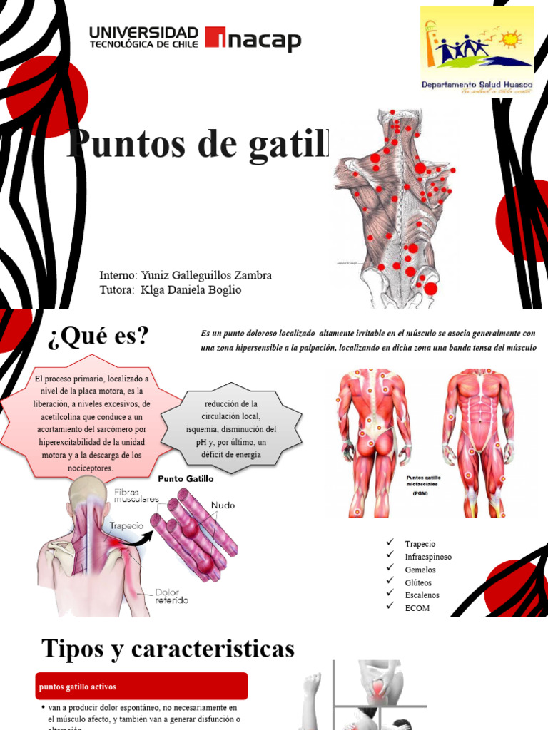 Puntos Gatillo: Causas y Tratamientos | PDF | Punto gatillo miofascial ...