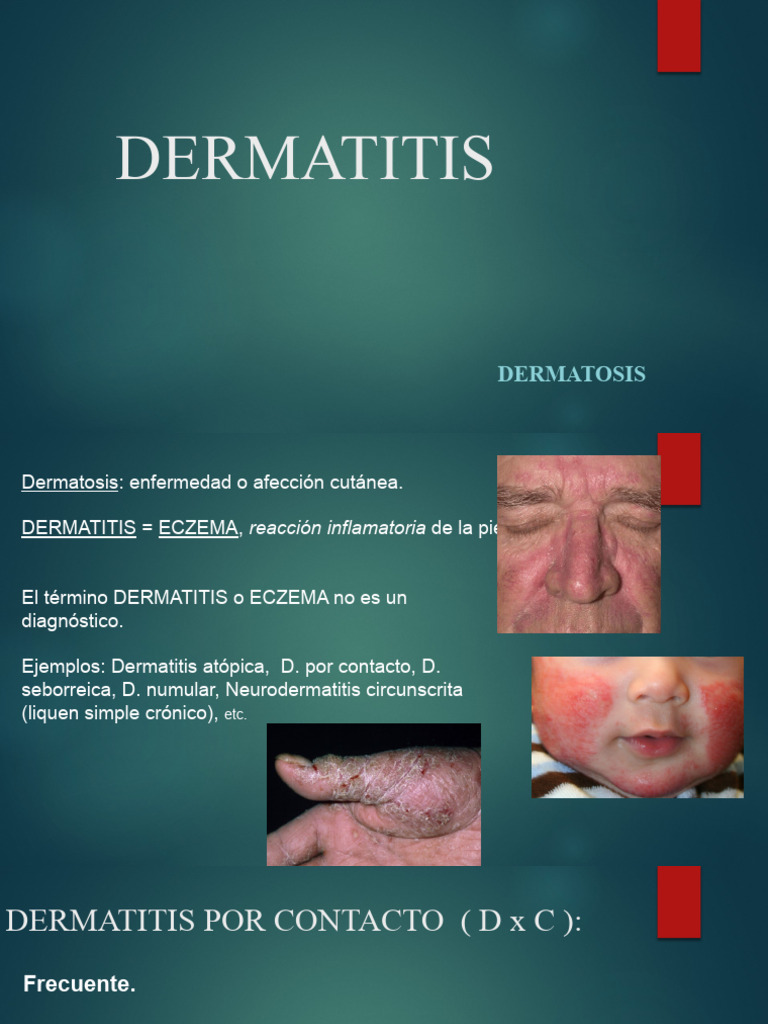 Dermatitis Por Contacto 1 | PDF