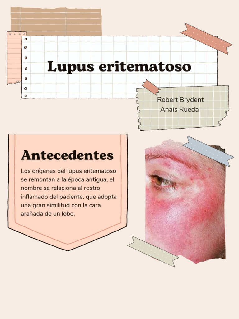 Lupus Eritematoso | PDF | Medicina CLINICA | Especialidades Medicas