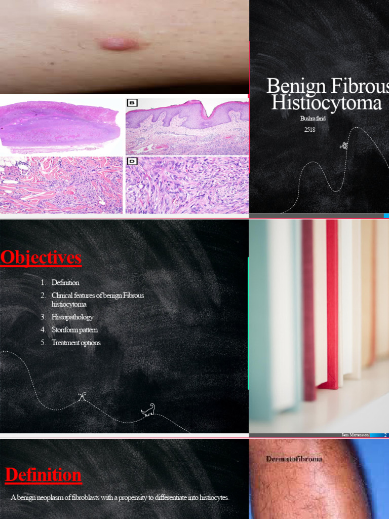 Benign Fibrous Histiocytoma | PDF | Connective Tissue | Benign Tumor