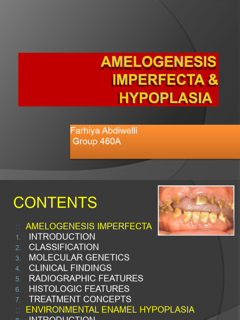 Hypoplasia, Flurosis, Amelogenesis Imperfecta and Abnormal DVPT of Tooth | PDF | Tooth Enamel ...