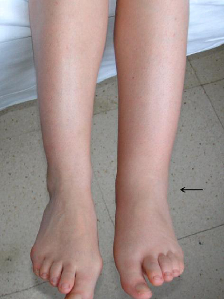 Leg Swelling | PDF