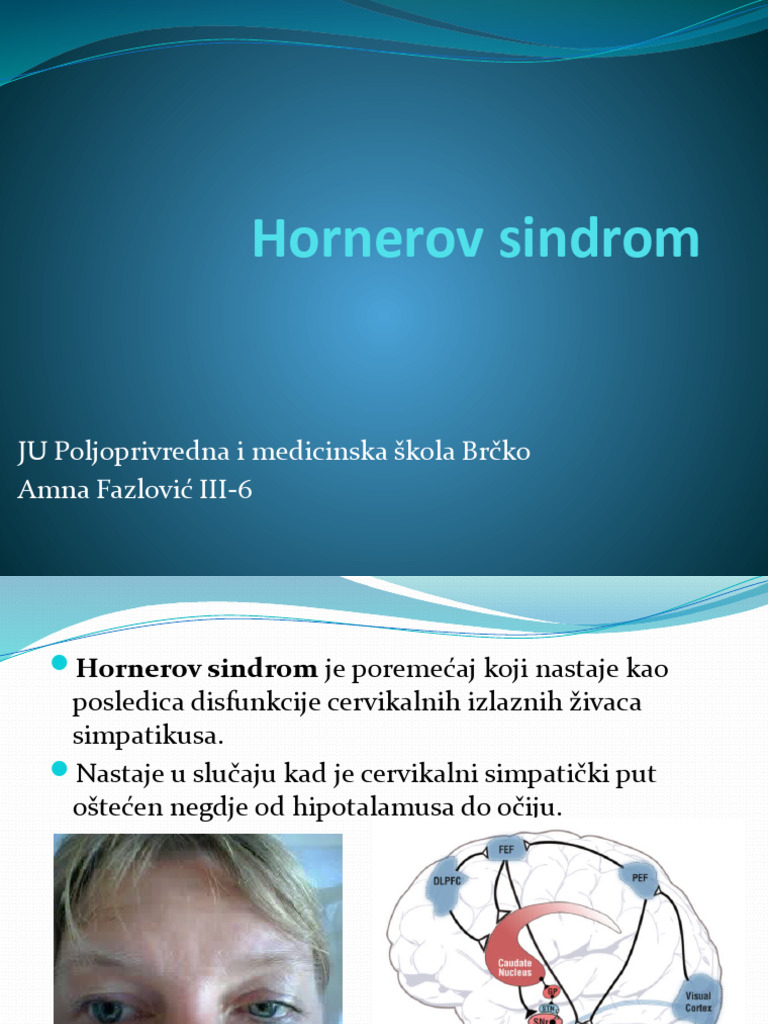 Hornerov Sindrom | PDF