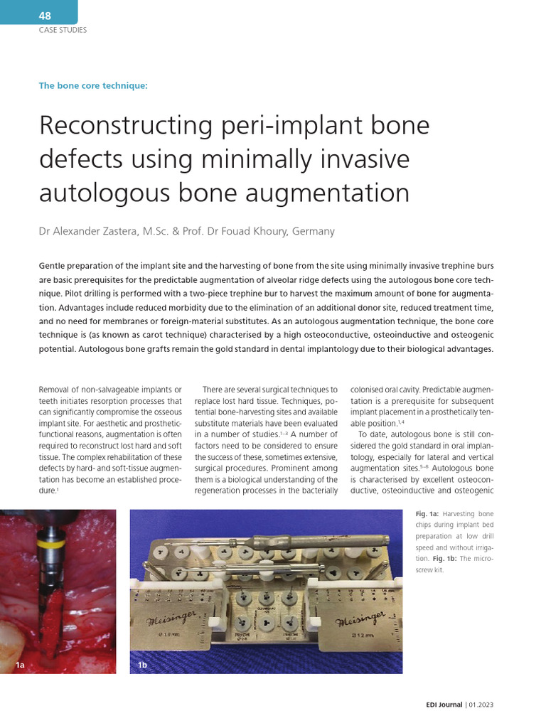The Bone Core Technique Reconstructing Peri Implant Bone Defects Using Minimally Invasive ...