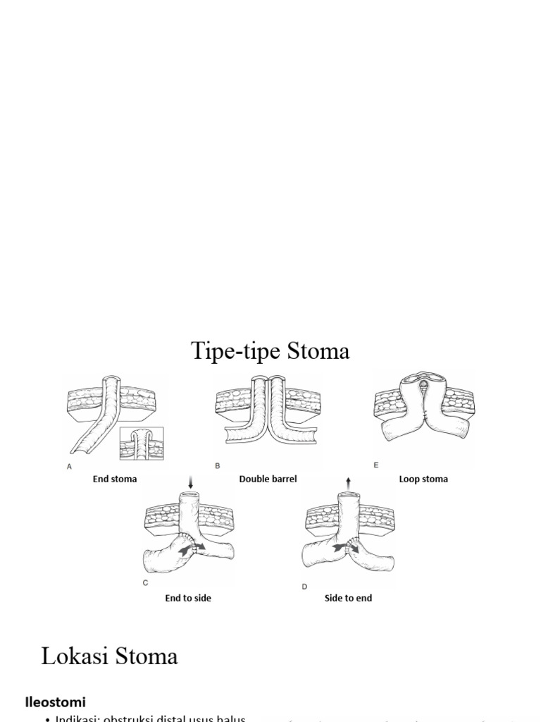 Tipe Tipe Stoma | PDF