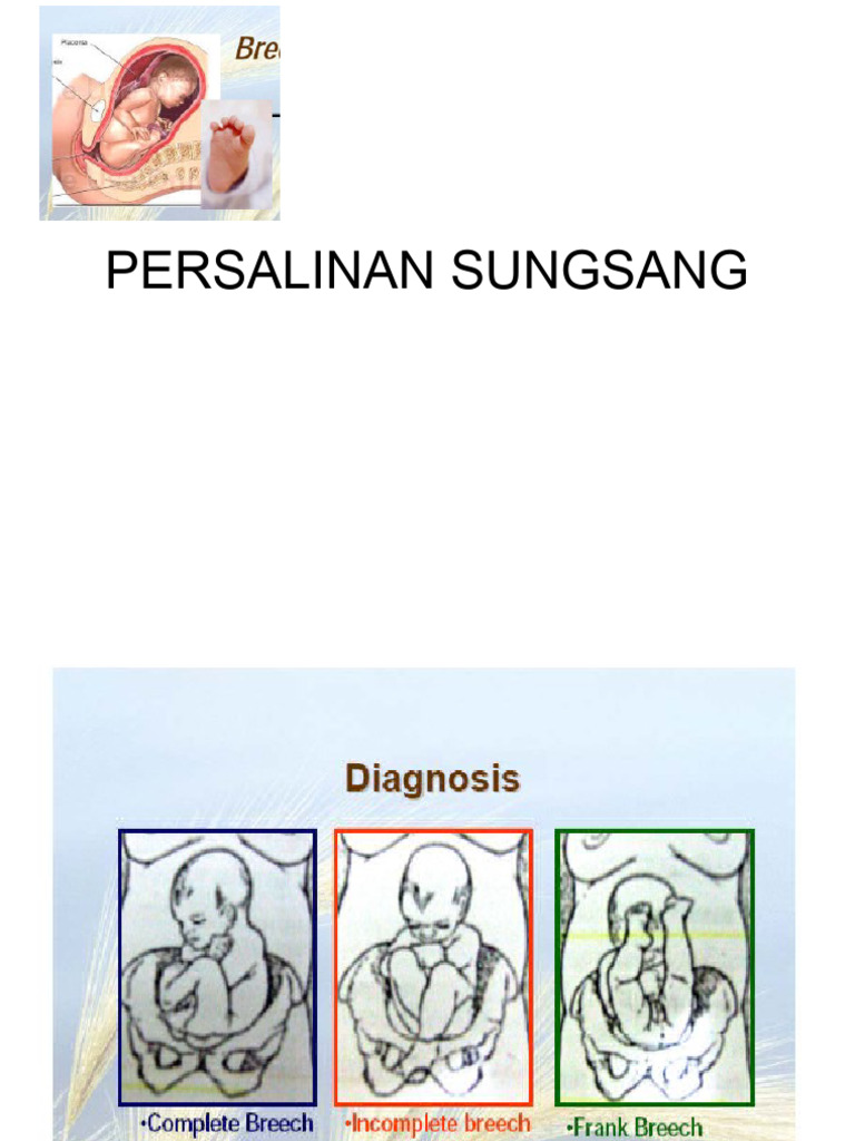 Persalinan Bokong | PDF
