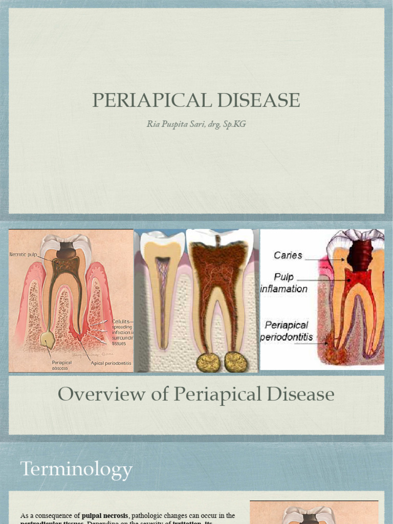 Periapical Disease N Endodontic Emergency | PDF | Healing | Inflammation