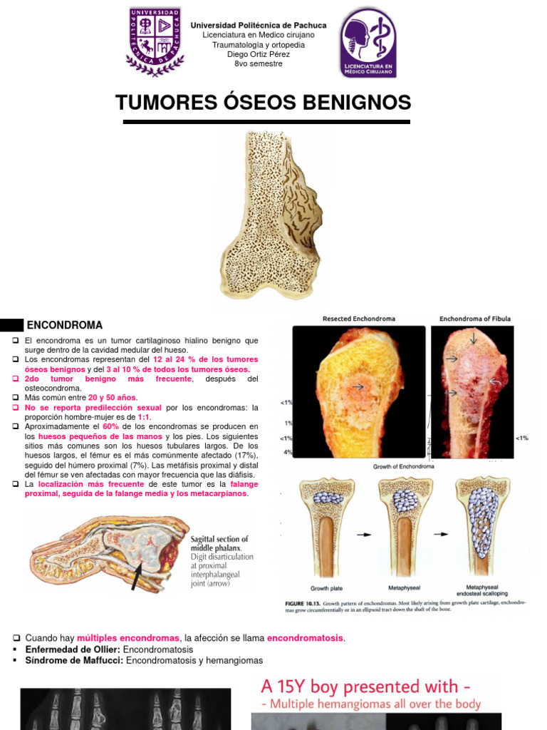 Tumores Oseos Benignos 1 | PDF